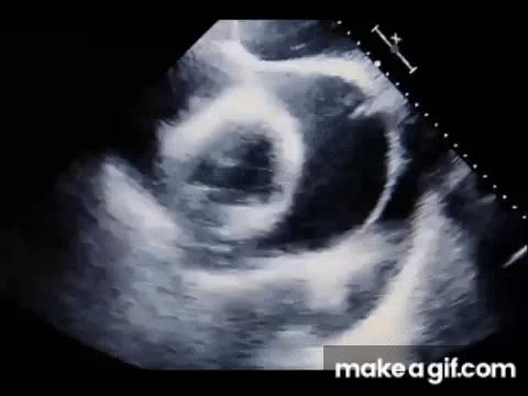 Transthoracic Echocardiogram Showing Pericardial Tamponade on Make a GIF