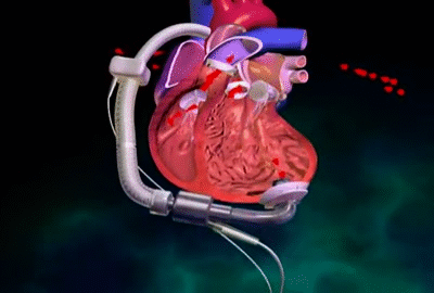 Heart Assist 5 - Micromed - Assist Device - LVAD on Make a GIF