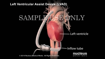 Left Ventricular Assist Device (LVAD) on Make a GIF