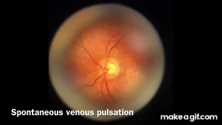 Spontaneous venous pulsation on Make a GIF
