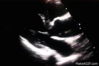 Echocardiogram - aortic dissection (Ecocardiograma - Dissecção de aorta ...