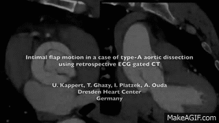 Intimal flap motion in a case of type A aortic dissection using ...