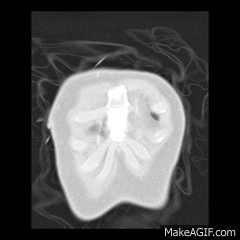 20180510 Chest CT Coronal View on Make a GIF