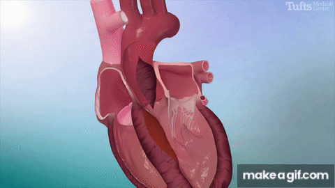 Septal Myectomy: Surgical Procedure for Hypertrophic Cardiomyopathy ...