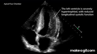 Echo Case #1 | Cardiac Amyloidosis on Make a GIF