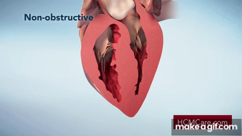 Hypertrophic Cardiomyopathy (HCM) Mechanism of Disease Video on Make a GIF