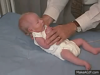 4.23 - Primitive Reflexes, Moro Reflex - Newborn Abnormal - Infant ...