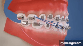 Class III Elastics - Lateral View (HD) on Make a GIF