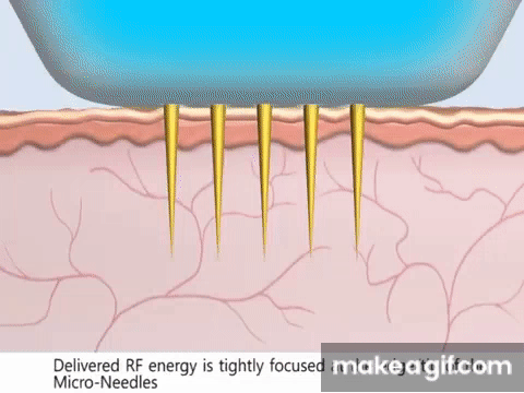 Animation Radiofréquence MicroNeedle Secret on Make a GIF