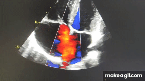 Ostium secundum atrial septal defect (echocardiography) on Make a GIF