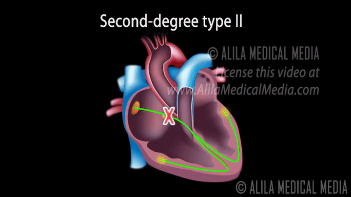 Atrioventricular Block (AV block) - Types of Heart Block Part 2 ... Atrioventricular Block (AV block) - Types of Heart Block Part 2 ...