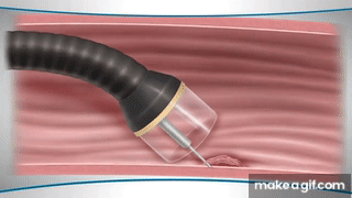 Learn About an Endoscopic Mucosal Resection on Make a GIF