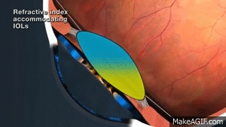 Cataract Removal and Intraocular Lenses on Make a GIF