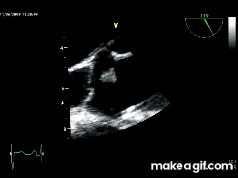 BIG AORTIC VEGETATION / INFECTIVE ENDOCARDITIS ECHOCARDIOGRAPHY cardiac ...