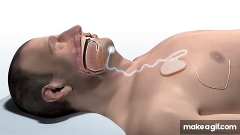 Inspire Therapy for Obstructive Sleep Apnea on Make a GIF