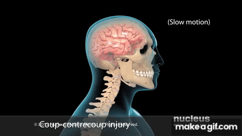 Mild Traumatic Brain Injury on Make a GIF