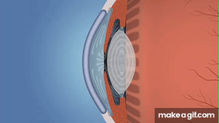 Closed Angle Glaucoma on Make a GIF