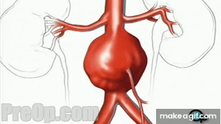 Abdominal Aortic Aneurysm - Open Repair Surgery - PreOp® Patient ...