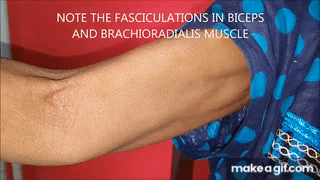 ALS fasciculations (Amyotrophic lateral sclerosis)(Motor neuron disease ...