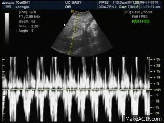Our 3d/4d ultrasound at 28 weeks and Baby's Heartbeat at 28 weeks on ...