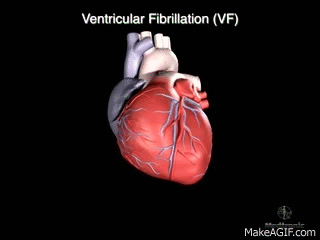What is Ventricular Fibrillation on Make a GIF