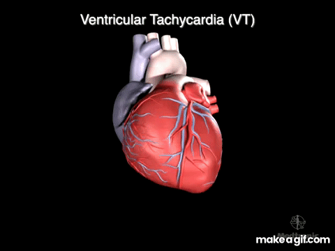What is Ventricular Tachycardia on Make a GIF