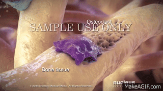 Osteoporosis on Make a GIF