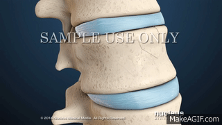 Osteoporosis on Make a GIF