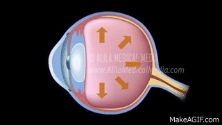 Development of Glaucoma Animation, Open Angle vs Angle Closure Glaucoma ...