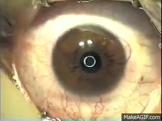 My Lasik Eye Surgery on Make a GIF