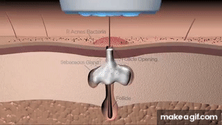 Remove Acne with Acne Treatment laser Pen / Safe, Effective and ...