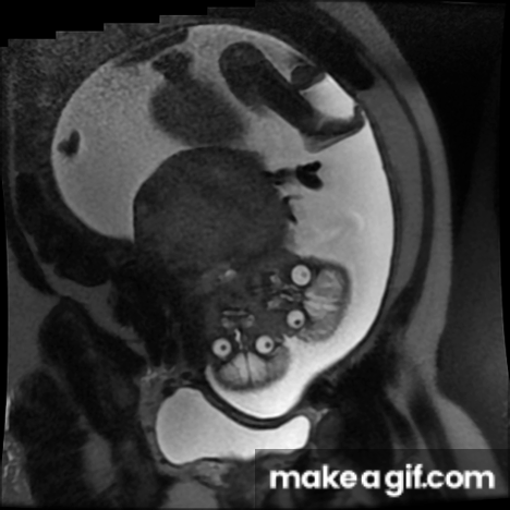 Conjoined Twins on Make a GIF