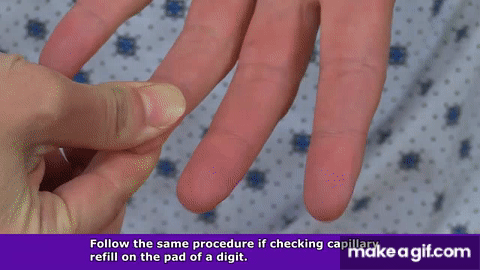 Capillary Refill Time Test: Normal vs Abnormal - Nursing Clinical ...