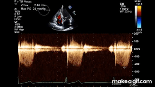 Normal Complete 2D Echocardiogram with Color Doppler and Spectral ...