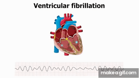 Ventricular Fibrillation (V-Fib): Terminal Cardiac Rhythm on Make a GIF