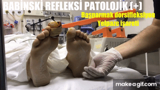 BABİNSKİ REFLEKSİ BAKILIŞI; NORMAL VE PATOLOJİK HALİ on Make a GIF