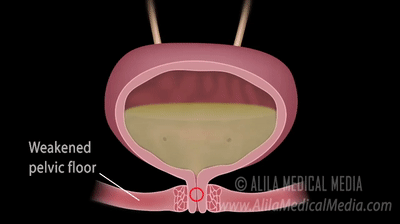 Stress Urinary Incontinence in Women Animation Tutorial on Make a GIF