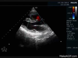 TETRALOGY OF FALLOT (TOF) - ECHOCARDIOGRAPHY SE on Make a GIF