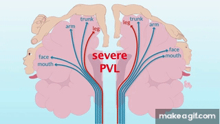 "Periventricular Leukomalacia" by Anne Hansen, MD, MPH for ...