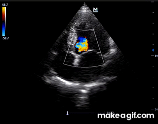understanding colour Doppler in one minute on Make a GIF