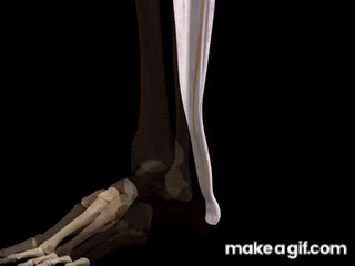 Achilles Tendon Rupture | Complete Anatomy on Make a GIF
