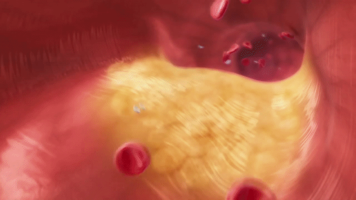 Acute Coronary Syndrome (ACS) Pathology on Make a GIF