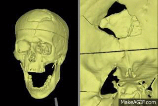 phineas gage injury on Make a GIF