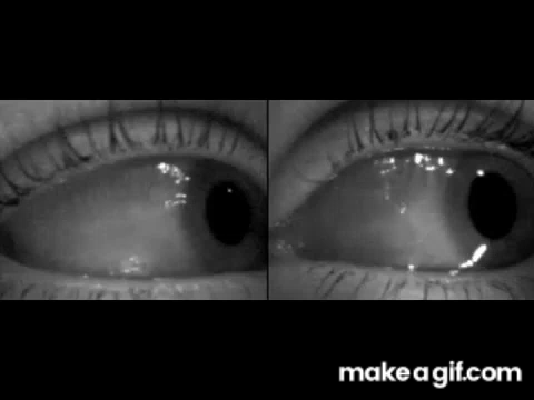 Gaze evoked nystagmus to left on Make a GIF