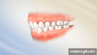 Orthodontic Appliance - RPE (Rapid Palatal Expander) on Make a GIF