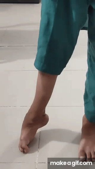 Equinovarus deformity of foot (Club Foot) on Make a GIF
