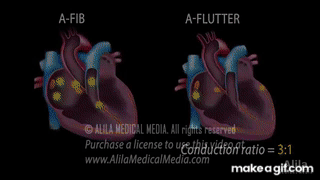 Wolff-Parkinson-White Syndrome Pathophysiology, Pre-Excitation and AVRT ...