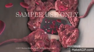 TVP e Embolia Pulmonar on Make a GIF