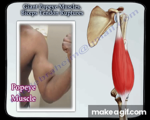 Muscles Biceps Tendon Ruptures on Make a GIF
