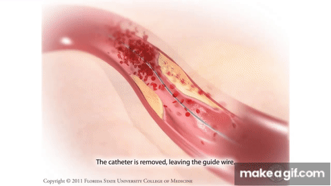 Percutaneous Coronary Intervention- Coronary Angioplasty on Make a GIF